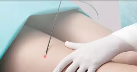 Clinic-Londýn-liposukcia-laser.